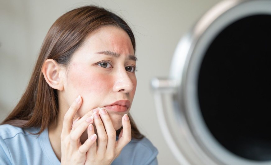 Iritasi: Penyebab, Gejala, dan Cara Mengatasinya - Snowhite Skincare
